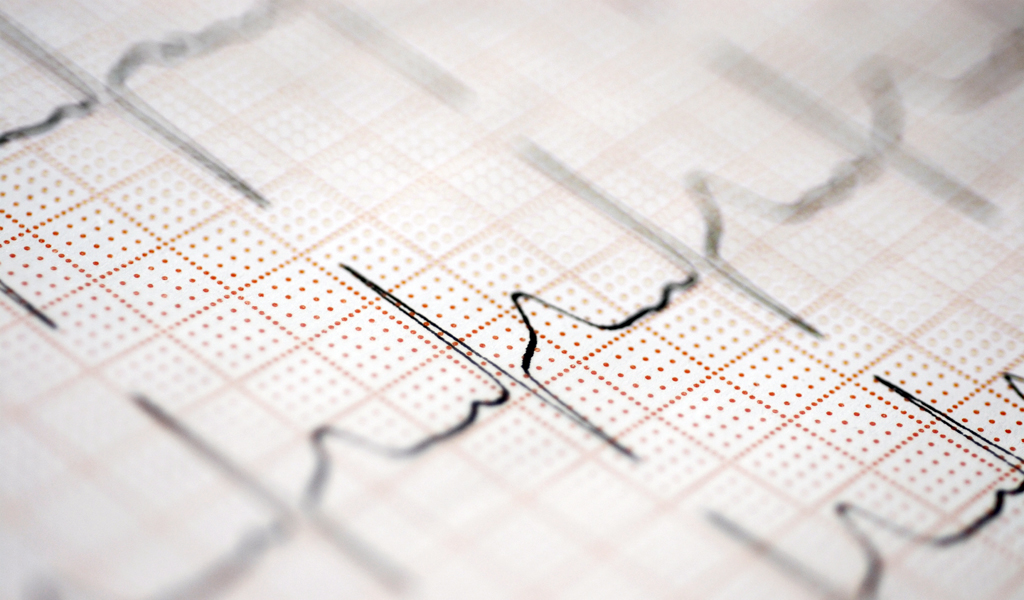 Cardiac monitoring part 1: Electrocardiography (ECG) | Nursing Times
