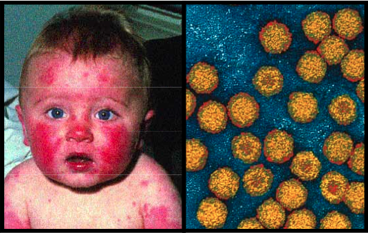 Erythema infectiosum | Nursing Times