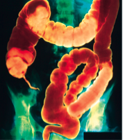 The use of phosphate enemas in the treatment of constipation. | Nursing ...