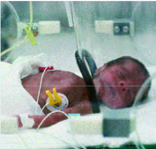 Causes and treatment of neonatal respiratory distress syndrome ...