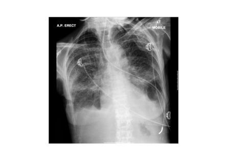 Nasogastric Tube In Brain