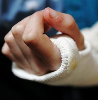 Patients should be told not to drive while wearing plaster casts ...