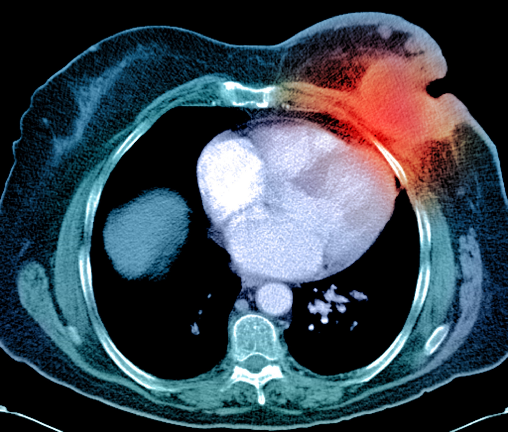 Breast cancer radiotherapy linked to angiosarcoma | Nursing Times