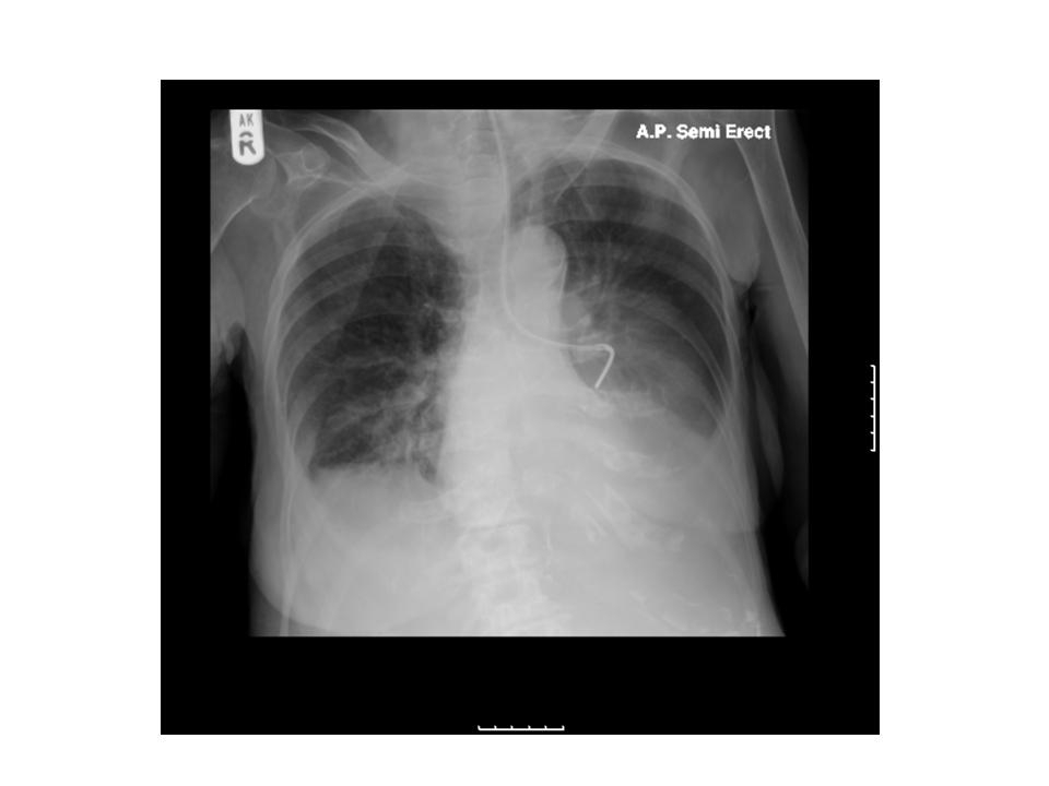 Nasogastric feeding tube placement: changing culture | Nursing Times