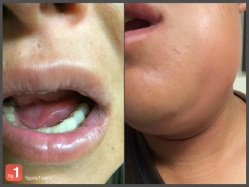 Ludwig's Angina | Nursing Times