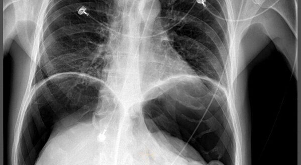 Pneumoperitoneum | Nursing Times