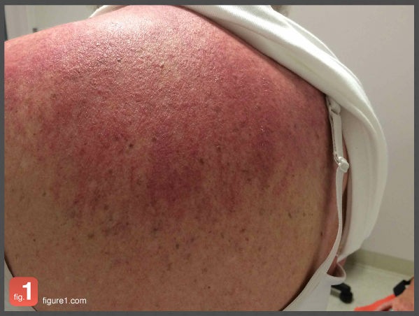 "Shawl Sign" | Nursing Times