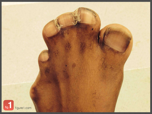 Apert Syndrome | Nursing Times