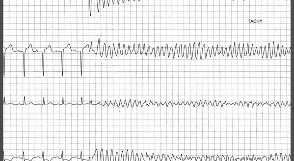 Ventricular Fibrillation