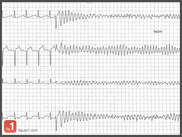 'Ventricular Fibrillation' | Nursing Times