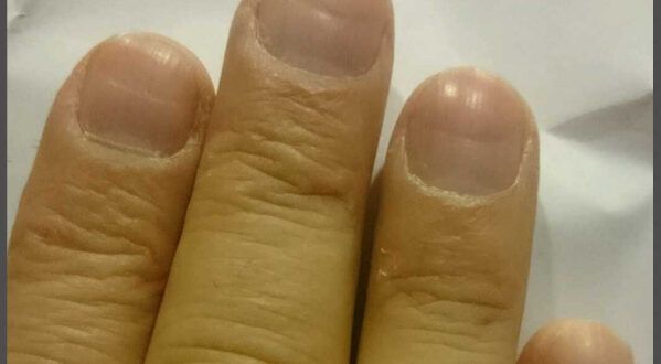 'Beau's Lines' | Nursing Times