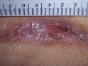 Wound management 6: How to address wound healing complications ...