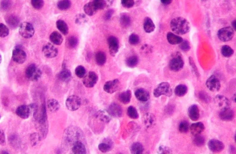 Pioneering end of life care guide for myeloma | Nursing Times