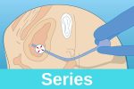 Urinary catheters 2: inserting a catheter into a female patient ...