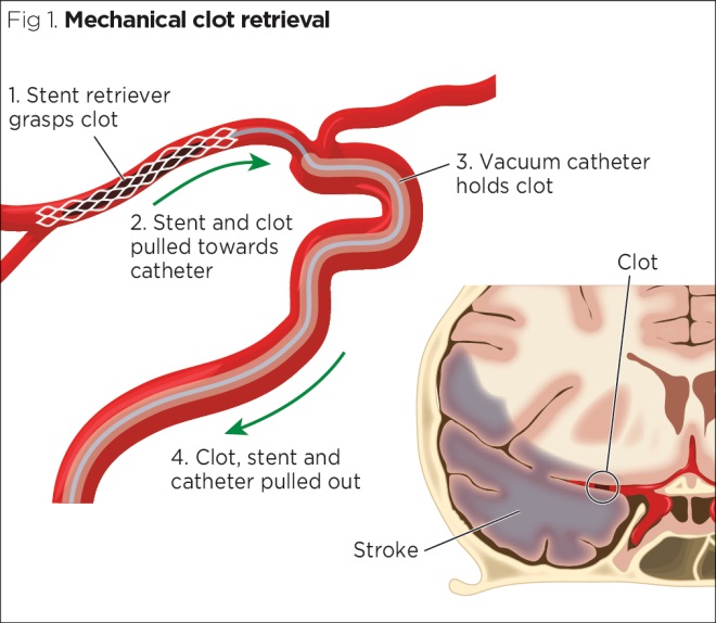 Stroke 4: immediate treatment of acute stroke and TIAs | Nursing Times
