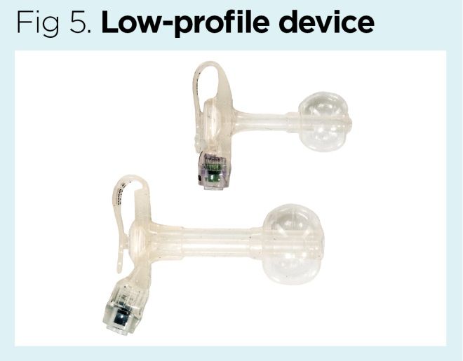 Selection and management of commonly used enteral feeding tubes ...