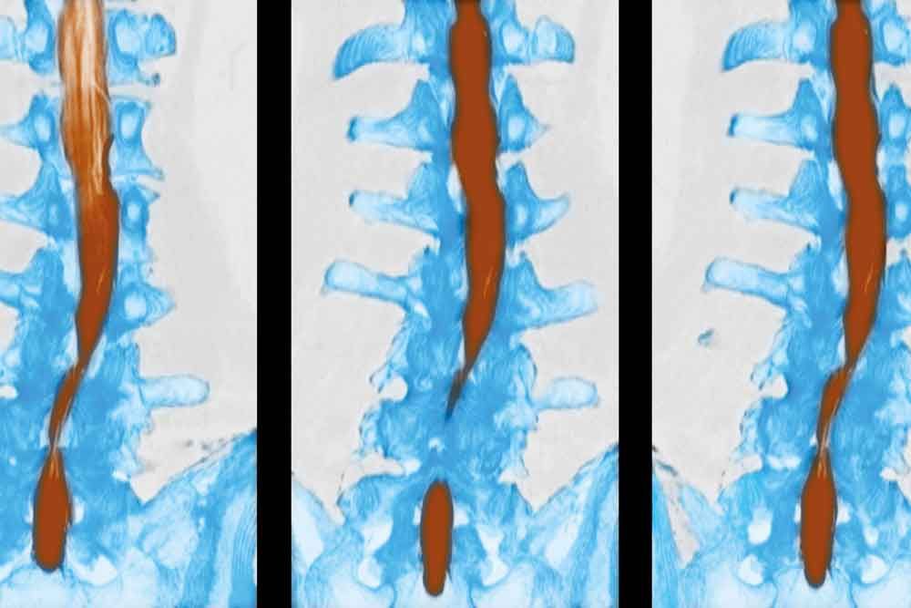 Management of patients with non-traumatic spinal cord injury | Nursing ...