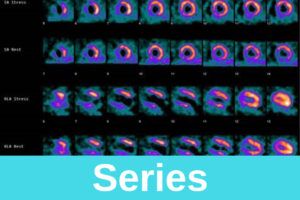 Nuclear medicine 3: myocardial perfusion imaging | Nursing Times