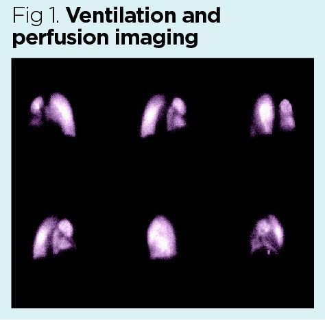 Nuclear medicine 5: ventilation/perfusion scintigraphy | Nursing Times