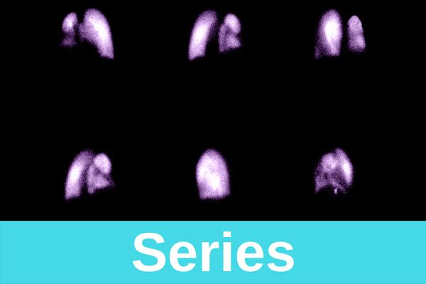 Lung Segments Vq Scan