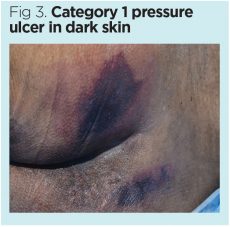 Pressure ulcer education 3: skin assessment and care | Nursing Times