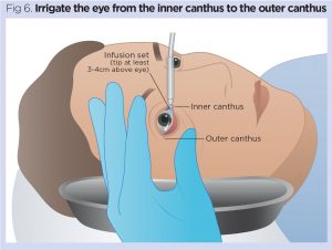 Procedure for eye irrigation to treat ocular chemical injury | Nursing ...
