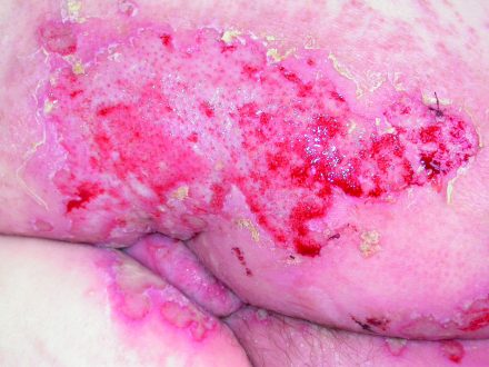 Pressure ulcer education 6: incontinence assessment and care | Nursing ...