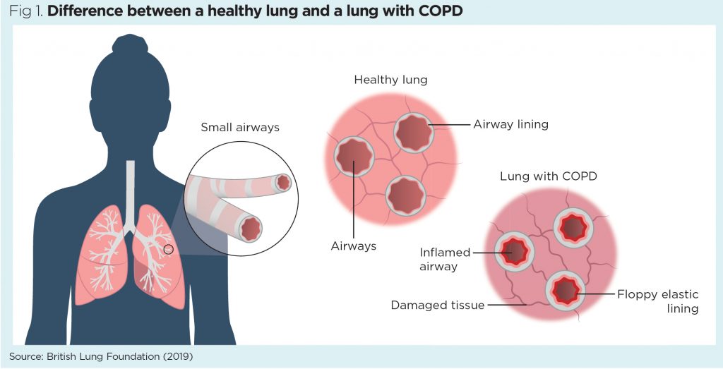COPD 1 Pathophysiology Diagnosis And Prognosis Nursing Times