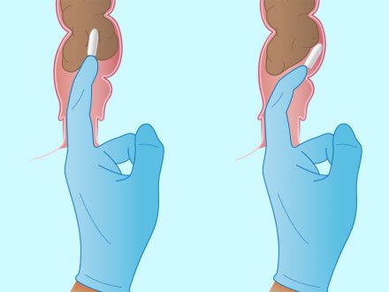 Overcoming barriers to nurses performing digital rectal examination ...