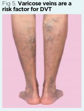 Clinical assessment of the leg for a suspected deep vein thrombosis ...