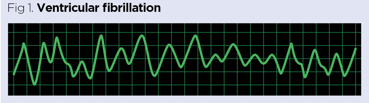 Out-of-hospital resuscitation 2: automated external defibrillator ...
