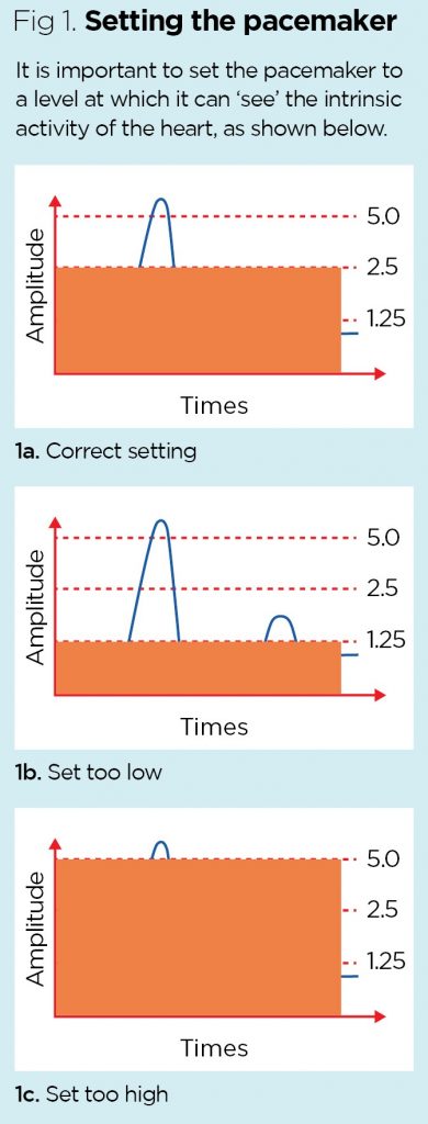 Pacemaker therapy 2: pacing functions and their role in patient care ...