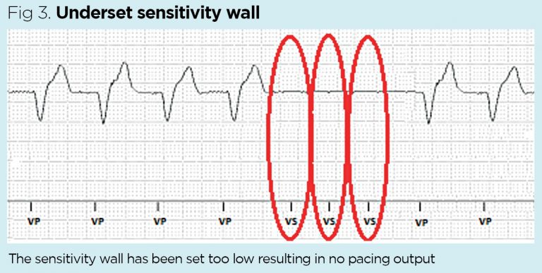 Pacemaker therapy 2: pacing functions and their role in patient care ...
