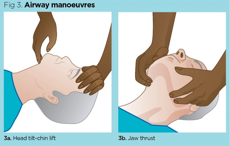 Essential critical care skills 4: airway assessment and management ...