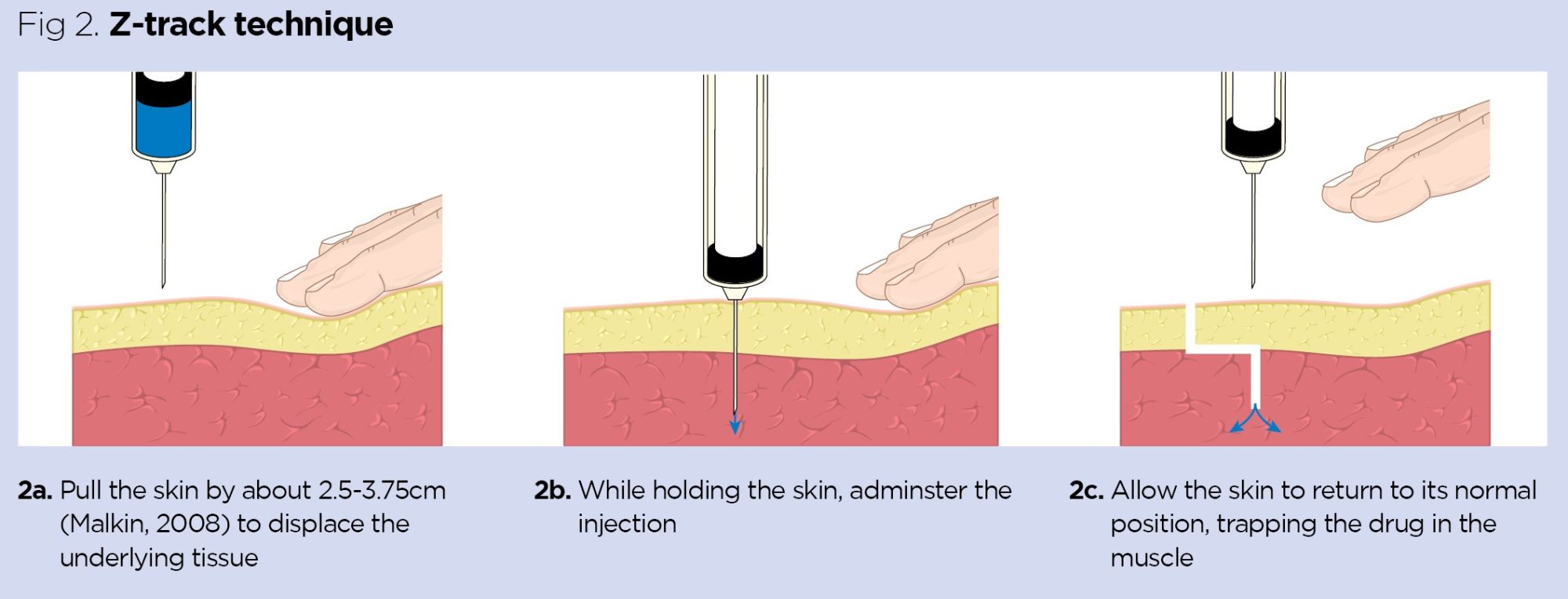 Injection technique 1: administering drugs via the intramuscular route ...