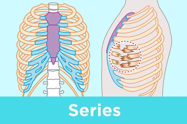 Trauma nursing 2: management of patients with rib fractures | Nursing Times