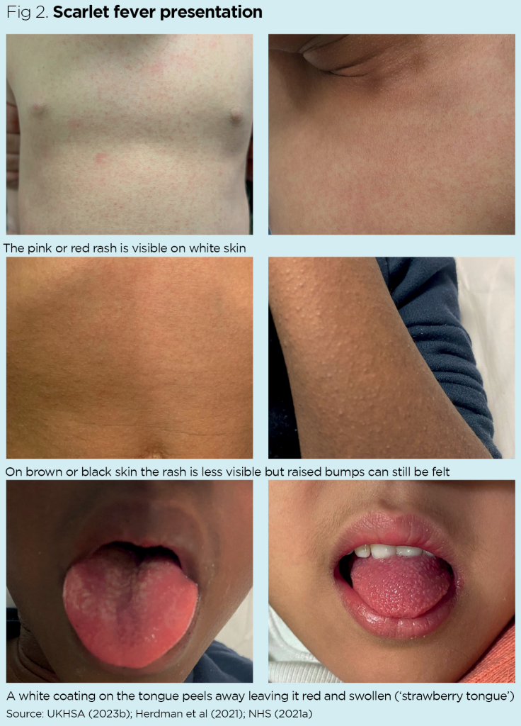 Early recognition and management of group A streptococcus infection ...