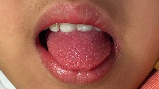 Early recognition and management of group A streptococcus infection ...