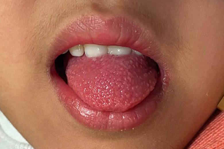 Early recognition and management of group A streptococcus infection ...