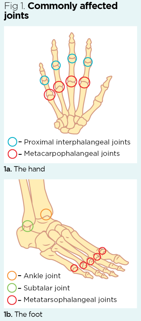 Rheumatoid arthritis diagnosis and management: a clinical update ...