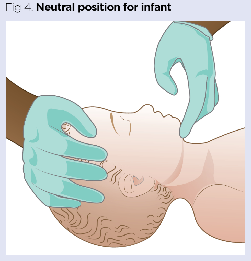 Paediatric emergency trolley 1: equipment to support airway and ...