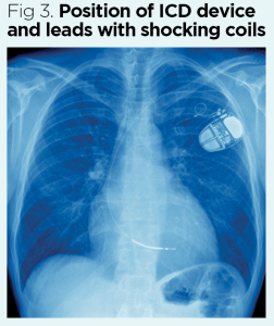 Complex cardiac device therapy 1: implantable cardioverter ...