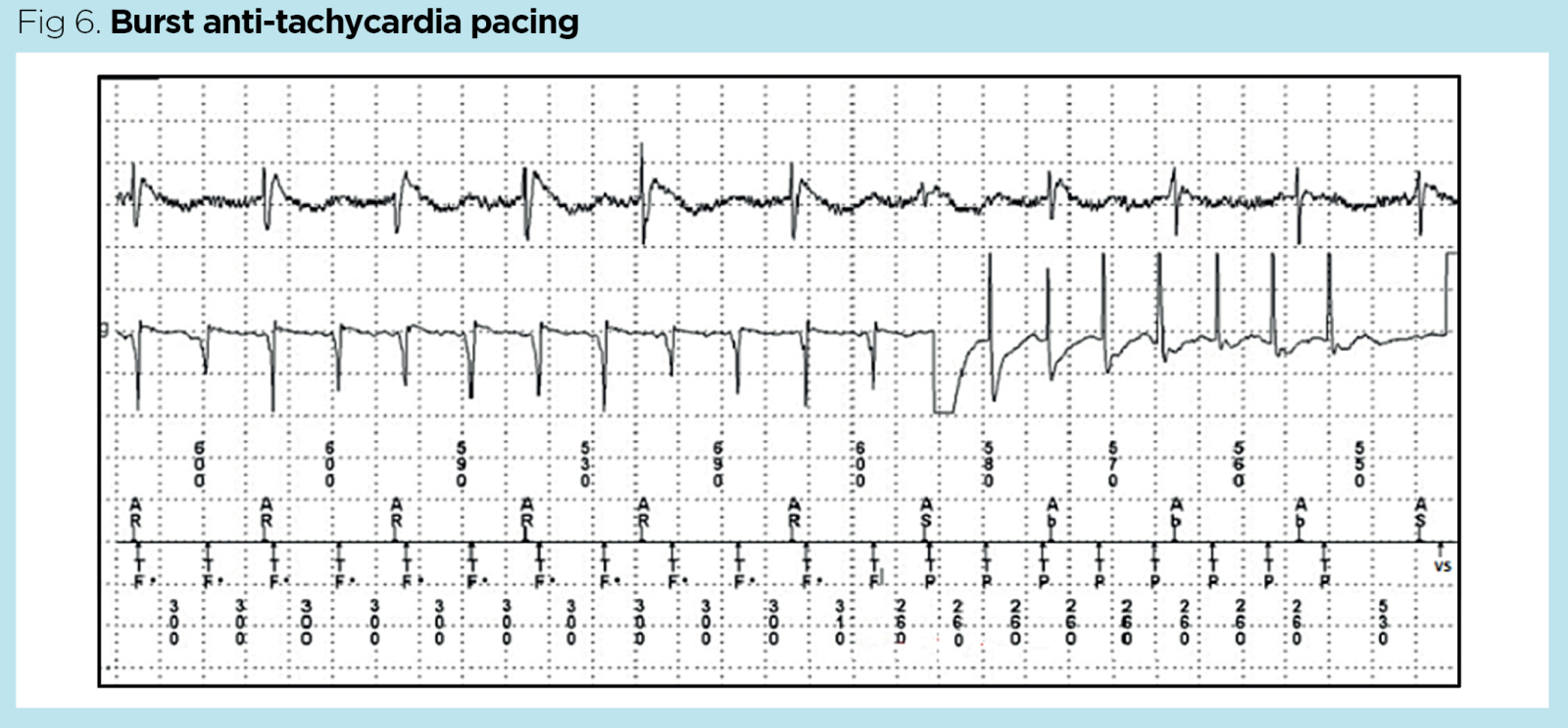 Complex cardiac device therapy 1: implantable cardioverter ...