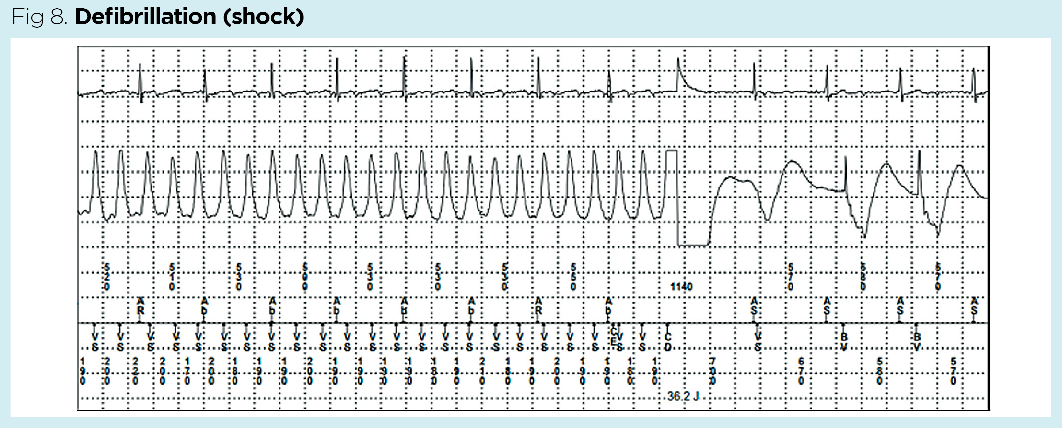 Complex cardiac device therapy 1: implantable cardioverter ...