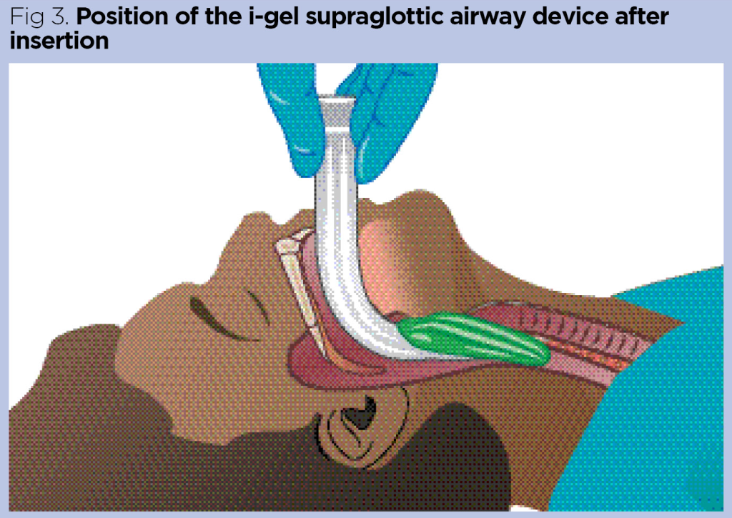 Adult emergency trolley 1: equipment to support airway and breathing ...