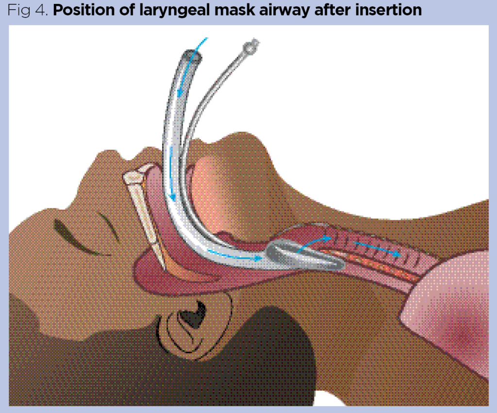 Adult emergency trolley 1: equipment to support airway and breathing ...