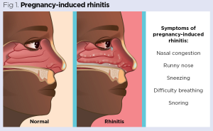 Pregnancy 2: effects on the respiratory and urinary systems | Nursing Times