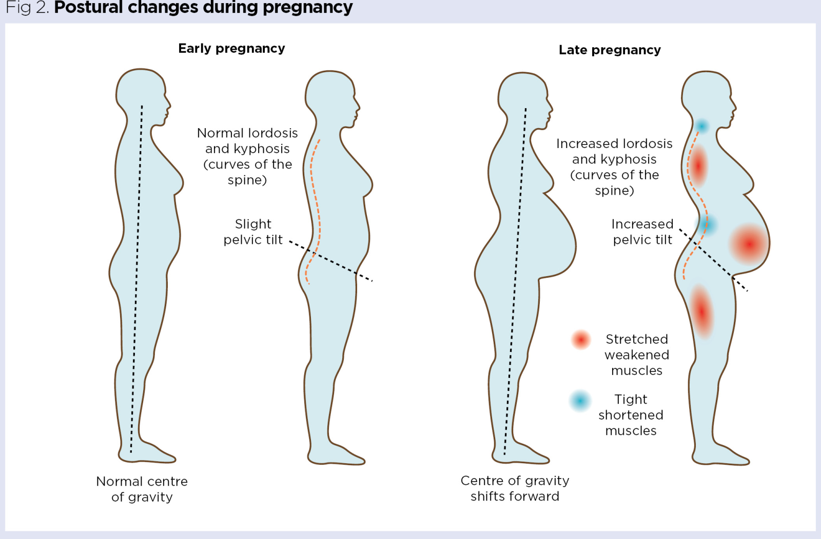 Pregnancy 3: effects on the musculoskeletal system and skin | Nursing Times
