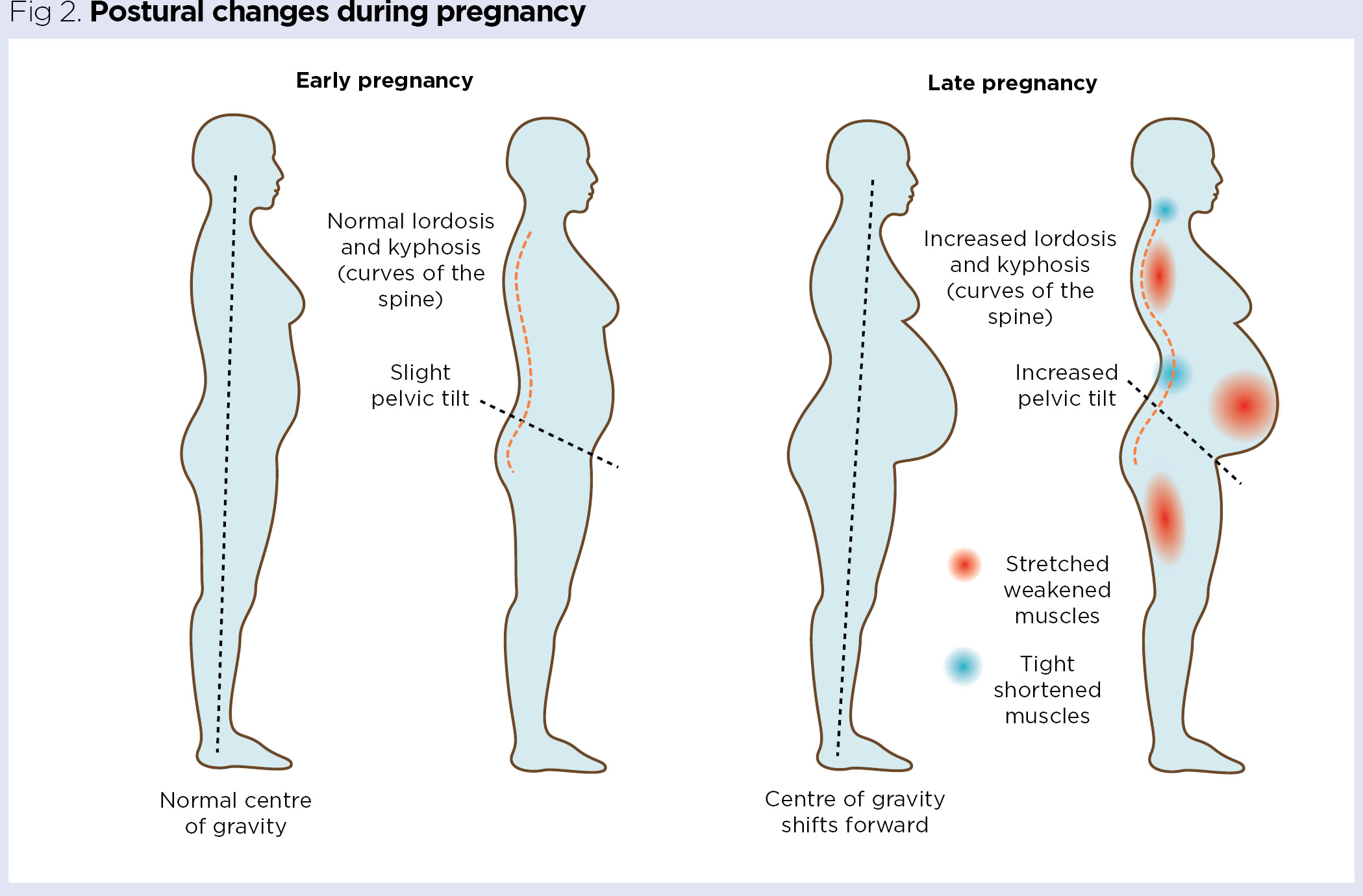 Pregnancy 3: effects on the musculoskeletal system and skin | Nursing Times