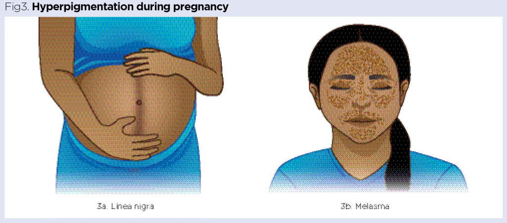 Pregnancy 3: effects on the musculoskeletal system and skin | Nursing Times